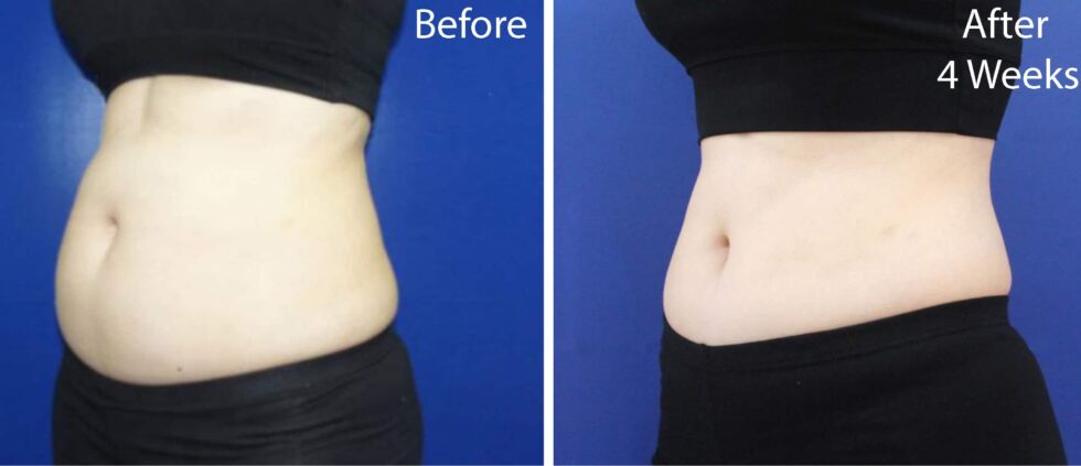 Body Contouring (LIPOcel) | Dothan Weight Loss
